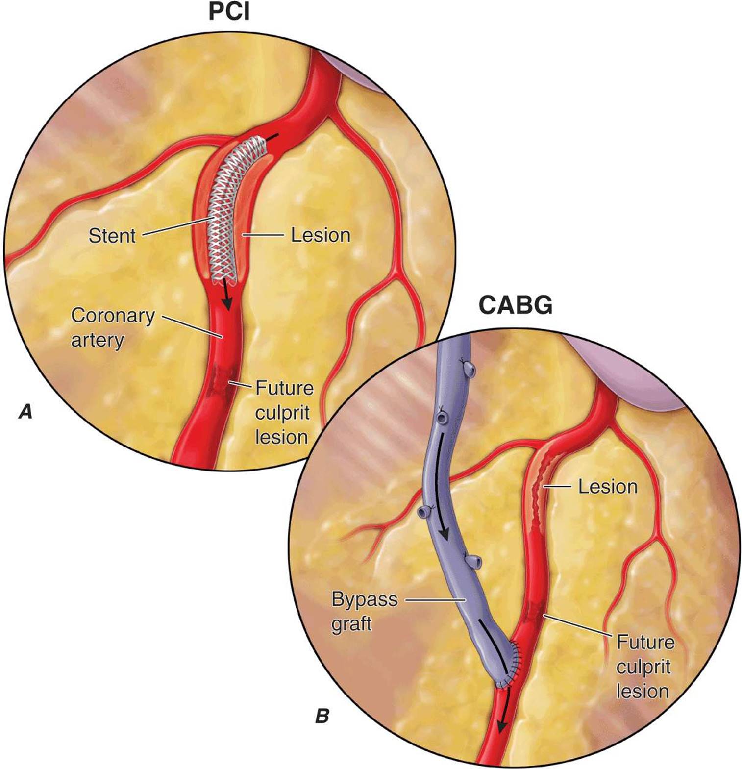 ISCHEMIC HEART DISEASE - DISORDERS OF THE VASCULATURE - Harrison's ...