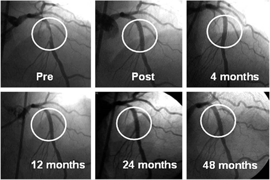 PERCUTANEOUS CORONARY INTERVENTIONS AND OTHER INTERVENTIONAL PROCEDURES ...