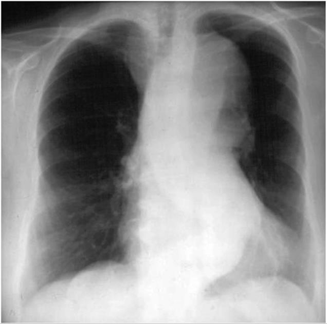 DISEASES OF THE AORTA - DISORDERS OF THE VASCULATURE - Harrison's ...