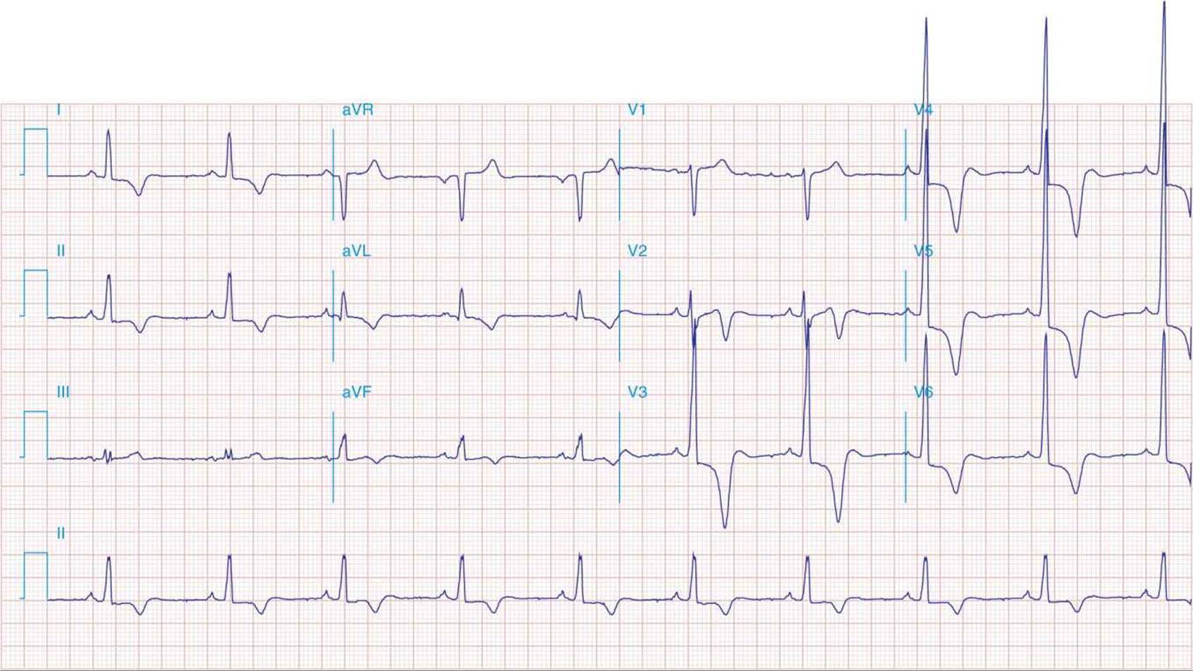 ATLAS OF ELECTROCARDIOGRAPHY - CARDIOVASCULAR ATLASES - Harrison's ...