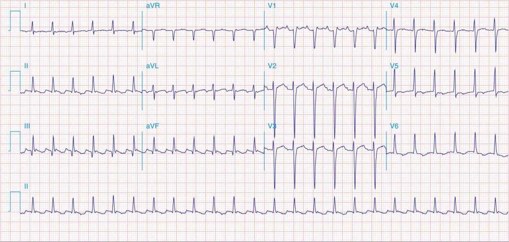 ATLAS OF CARDIAC ARRHYTHMIAS - CARDIOVASCULAR ATLASES - Harrison's ...