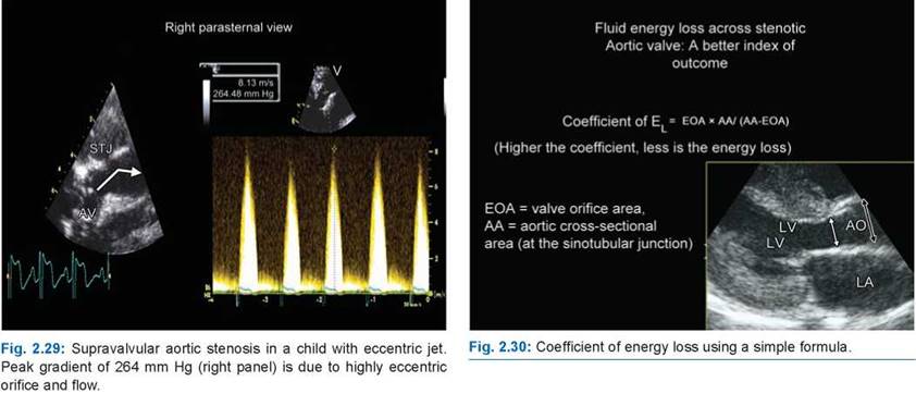 Hemodynamic Evaluation by Echo-Doppler Techniques - A Practical ...