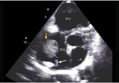 Tumors, Masses and infection - A Practical Approach to Clinical ...