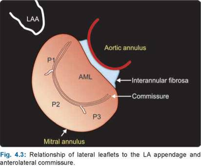 Mitral Regurgitation - A Practical Approach to Clinical ...