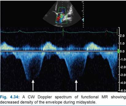 Mitral Regurgitation - A Practical Approach to Clinical ...