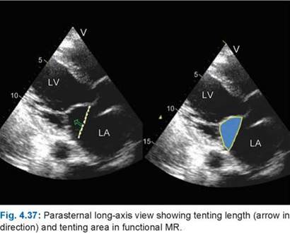 Mitral Regurgitation - A Practical Approach to Clinical ...