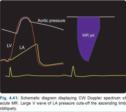 Mitral Regurgitation - A Practical Approach to Clinical ...