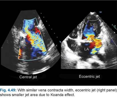Mitral Regurgitation - A Practical Approach to Clinical ...