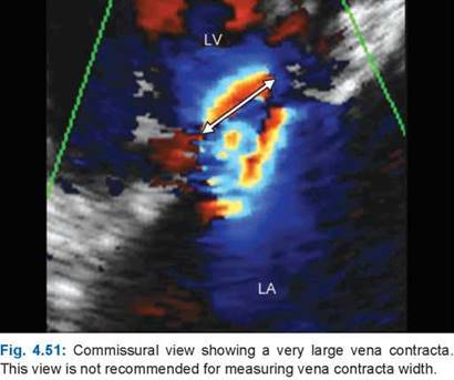 Mitral Regurgitation - A Practical Approach to Clinical ...