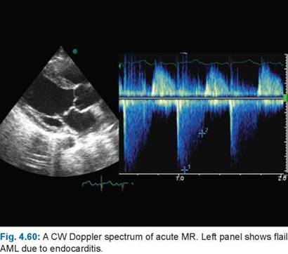 Mitral Regurgitation - A Practical Approach to Clinical ...