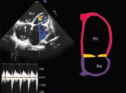 Tricuspid Valve - A Practical Approach to Clinical Echocardiography 1st ...