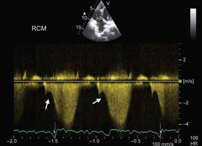 Tricuspid Valve - A Practical Approach to Clinical Echocardiography 1st ...
