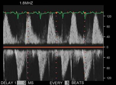 Tricuspid Valve - A Practical Approach to Clinical Echocardiography 1st ...