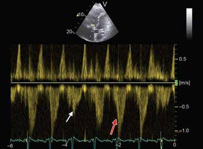Tricuspid Valve - A Practical Approach to Clinical Echocardiography 1st ...