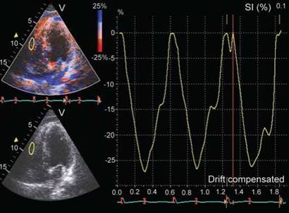 Echocardiographic Assessment of Right Ventricular Function: Methods and ...
