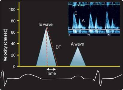 Diastolic Function - A Practical Approach to Clinical Echocardiography ...