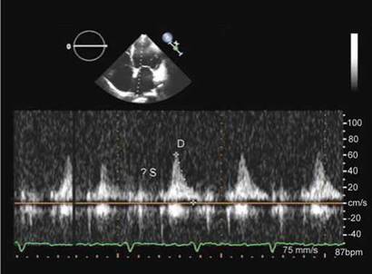 Diastolic Function - A Practical Approach to Clinical Echocardiography ...