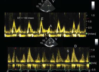 Diastolic Function - A Practical Approach to Clinical Echocardiography ...