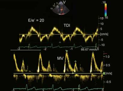 Tissue Doppler Echocardiography: Current Status and Applications - A ...