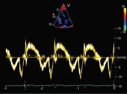Tissue Doppler Echocardiography: Current Status and Applications - A ...