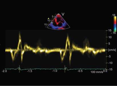 Tissue Doppler Echocardiography: Current Status and Applications - A ...