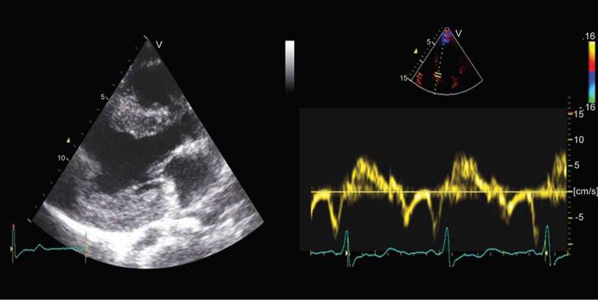 Tissue Doppler Echocardiography: Current Status and Applications - A ...