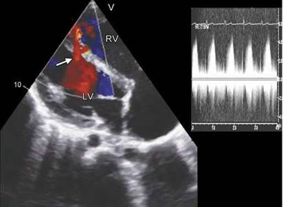 Congenital Heart Disease in Adults - A Practical Approach to Clinical ...