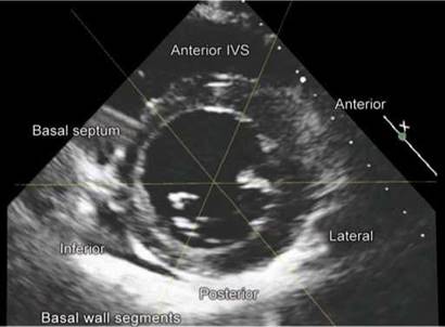 Ischemic Heart Disease - A Practical Approach to Clinical ...