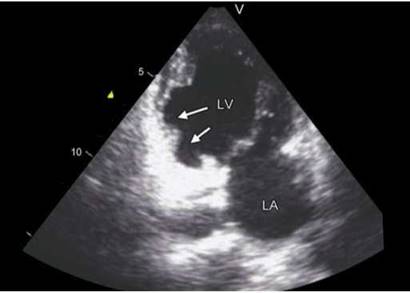 Ischemic Heart Disease - A Practical Approach to Clinical ...
