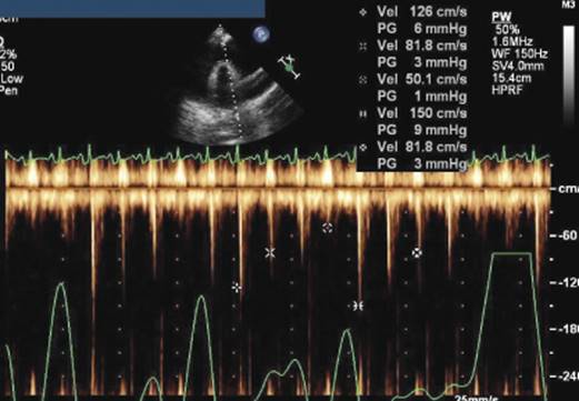 Chapter 23 - Echocardiography Board Review: 500 Multiple Choice ...