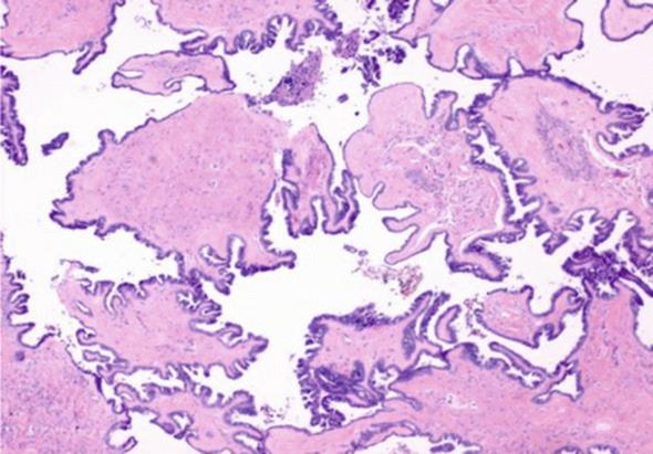 Low Malignant Potential Tumors - Frontiers in Gynecological ...