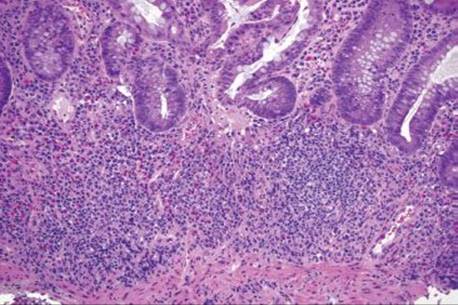 CHRONIC COLITIS PATTERN - COLON - Atlas of Gastrointestinal Pathology ...