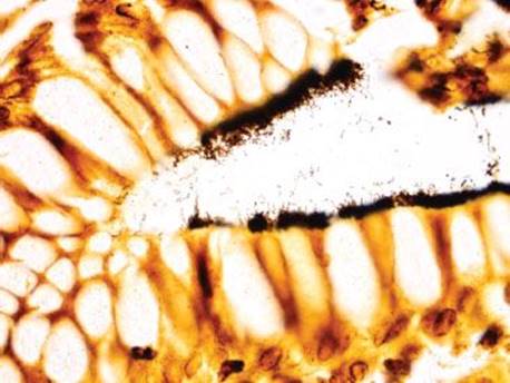 NEAR MISSES 4 - COLON - Atlas of Gastrointestinal Pathology: A Pattern ...