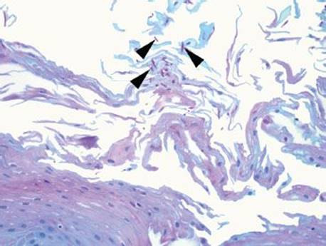 PARAKERATOTIC PATTERN - ESOPHAGUS - Atlas of Gastrointestinal Pathology ...