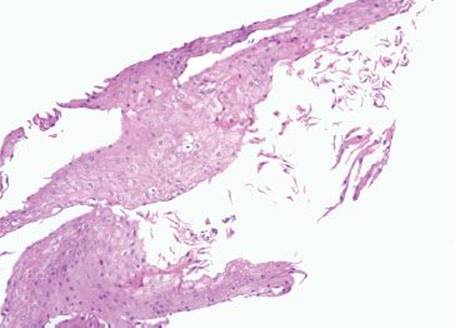 PARAKERATOTIC PATTERN - ESOPHAGUS - Atlas of Gastrointestinal Pathology ...
