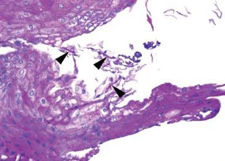 PARAKERATOTIC PATTERN - ESOPHAGUS - Atlas of Gastrointestinal Pathology ...