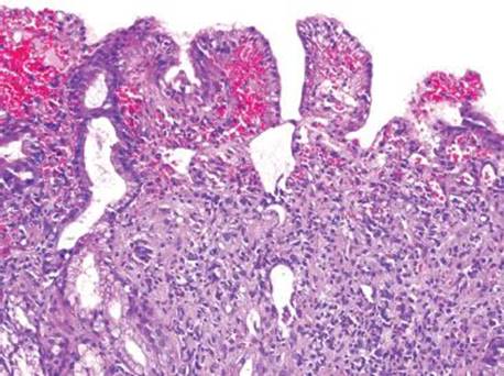 CRYPT ARCHITECTURAL DISTURBANCE PATTERN - SMALL BOWEL - Atlas of ...