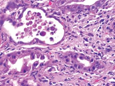 CRYPT ARCHITECTURAL DISTURBANCE PATTERN - SMALL BOWEL - Atlas of ...
