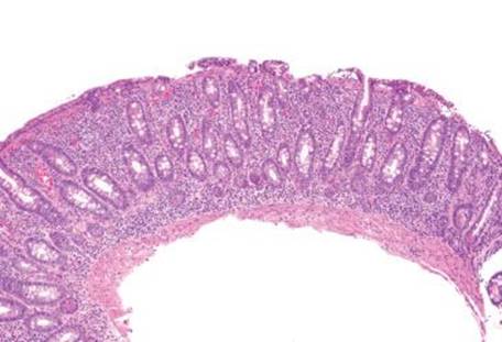 MALABSORTION PATTERN - SMALL BOWEL - Atlas of Gastrointestinal ...