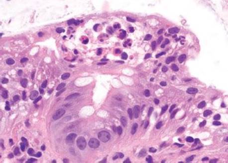 FOCAL ACTIVE COLITIS PATTERN - COLON - Atlas of Gastrointestinal ...