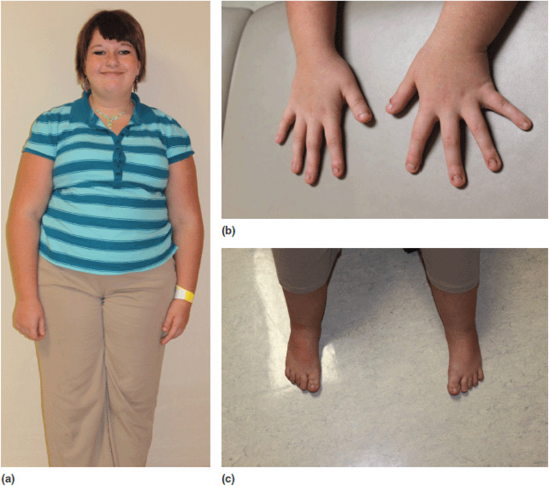 Atypical Modes of Inheritance - Medical Genetics 1st Ed