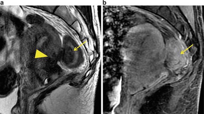 MR Imaging of Endometriosis - Endometriosis: Pathogenesis and Treatment ...