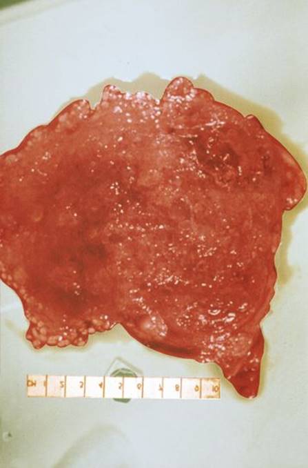 Gestational Trophoblastic Neoplasia - Hacker & Moore's Essentials of ...