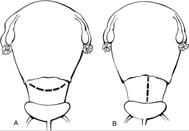 Cesarean Delivery - Danforth's Obstetrics & Gynecology, 9th Edition