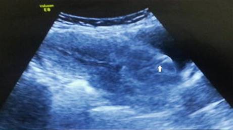 Rupture of the Uterus Scarred Due to Previous Caesarean Section ...