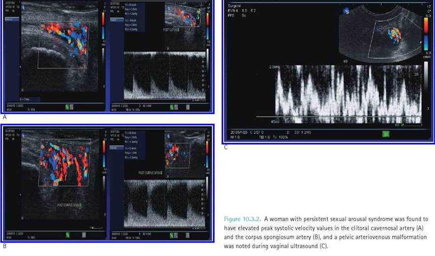 Blood flow: duplex Doppler ultrasound - Women's Sexual Function and ...