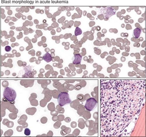 Acute Leukemias - Wintrobe's Atlas of Clinical Hematology, 1st Edition
