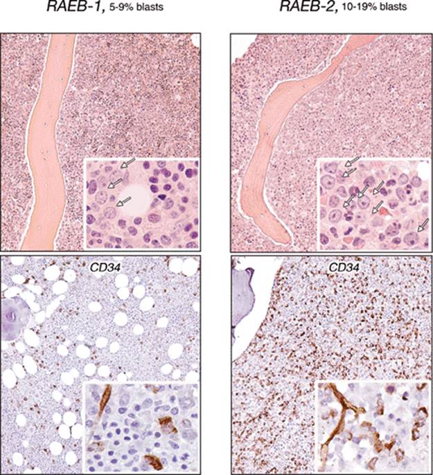 Myelodysplastic Syndromes - Wintrobe's Atlas of Clinical Hematology ...