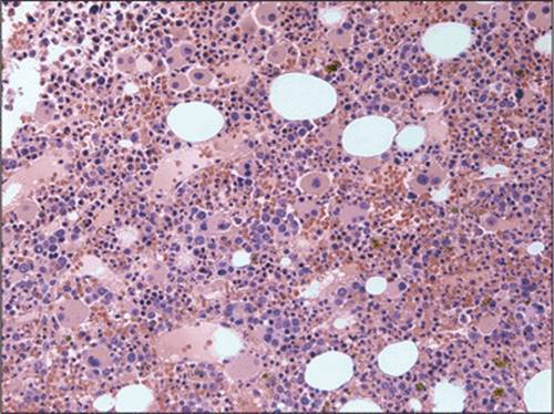 Chronic Myeloproliferative Syndromes - Wintrobe's Atlas of Clinical ...