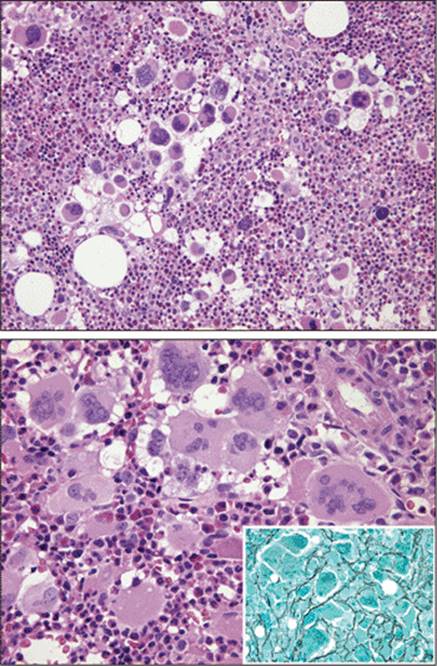 Chronic Myeloproliferative Syndromes - Wintrobe's Atlas of Clinical ...